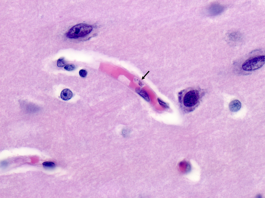 Malaria – CHAMPS Health
